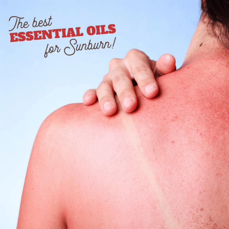 Best Essential Oils for Soothing Sunburn